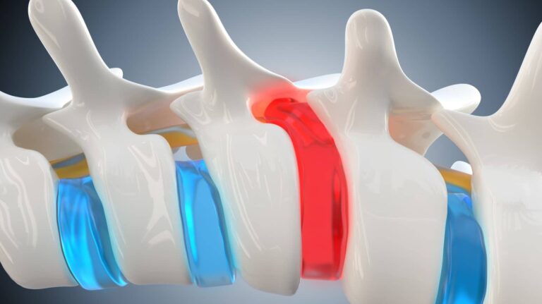 Les différents types de hernies | Dr Servajean